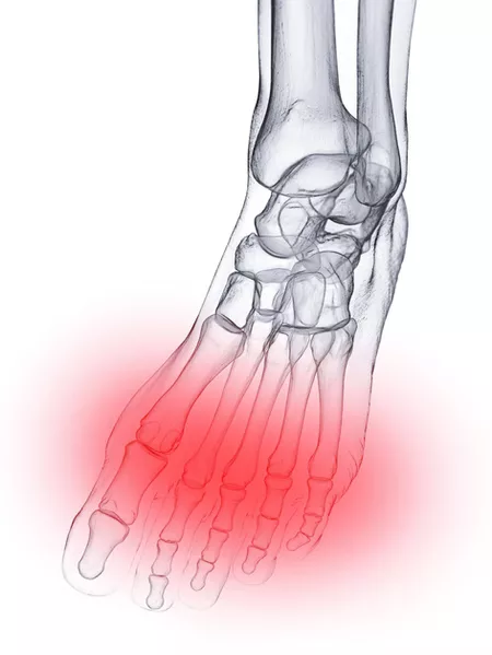 Résection et Arthrodèse de Synostose à Rueil | Dr Tournemine
